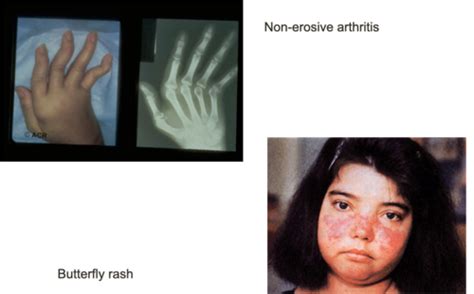 Sle Flashcards Quizlet