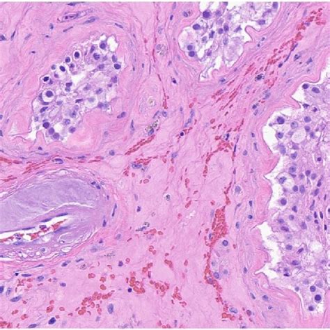 Testis Demonstrating Peritubular And Interstitial Fibrosis Maturation Download Scientific