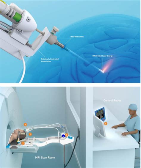 Mri Guided Laser Interstitial Thermal Therapy Litt