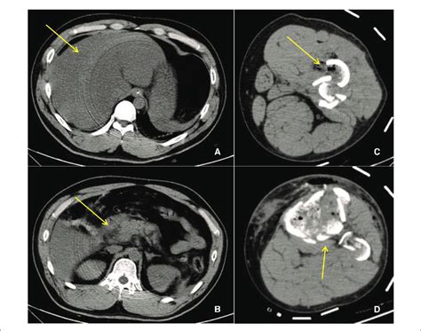 Ct Manifestation Post Polytrauma A Liver Rupture Perihepatic