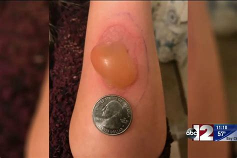 Initial Recluse Spider Bite