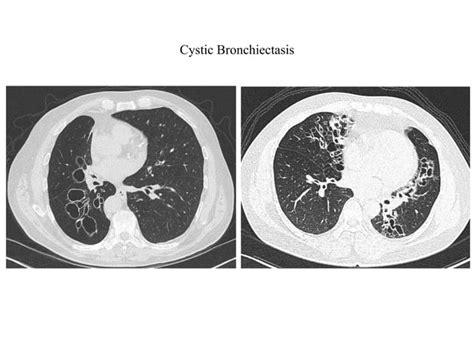 Differential Diagnosis Of Pulmonary Cyst 1 Bullous Emphysema 2 Cystic Bronchiectasis 3