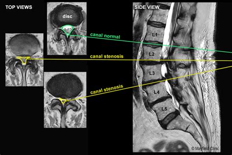 Spinal Stenosis Mri