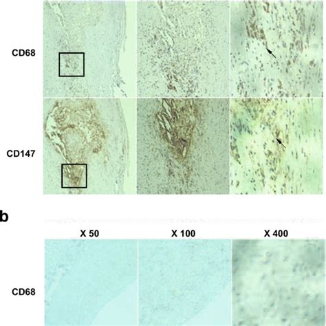 Immunohistochemical Staining Of Cd147 And Macrophages In Vulnerable