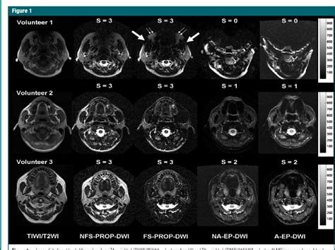 Figure 1 From Salivary Glands Echo Planar Versus Propeller Diffusion