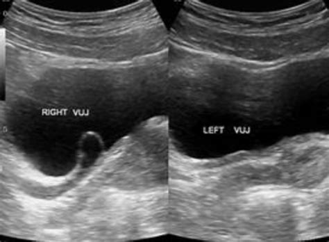 BLADDER Anatomy Pathology Flashcards Quizlet