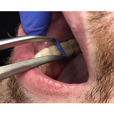 Ortho Organizer Elastic Separators Pack Of 1000