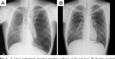 Figure 1 From Pleural Decortication For Trapped Lung Caused By Long