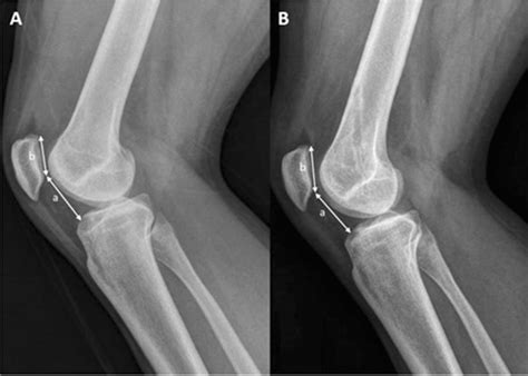 Radiographic Patellar Height Indices A ÷ B A Pre Operative