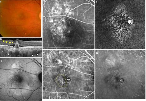 Ophthopedia On Linkedin Macular Neovascularization And Polypoidal Choroidal Vasculopathy …