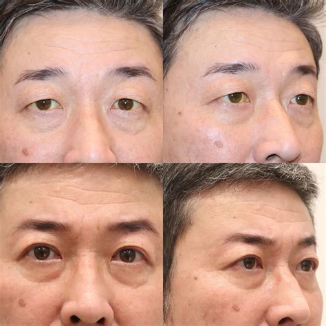 自由が丘 まぶたと眼のクリニック 眼瞼下垂術前術後です。 もともと、ダンディな方でしたが、さらによくなられました！頭痛やら肩こりも楽になったそうです。 眼瞼下垂二重切開逆さまつ毛