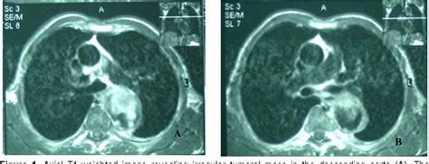 Aortic Angiosarcoma Semantic Scholar