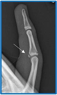Volar Plate Injury Bayside Hand Therapy