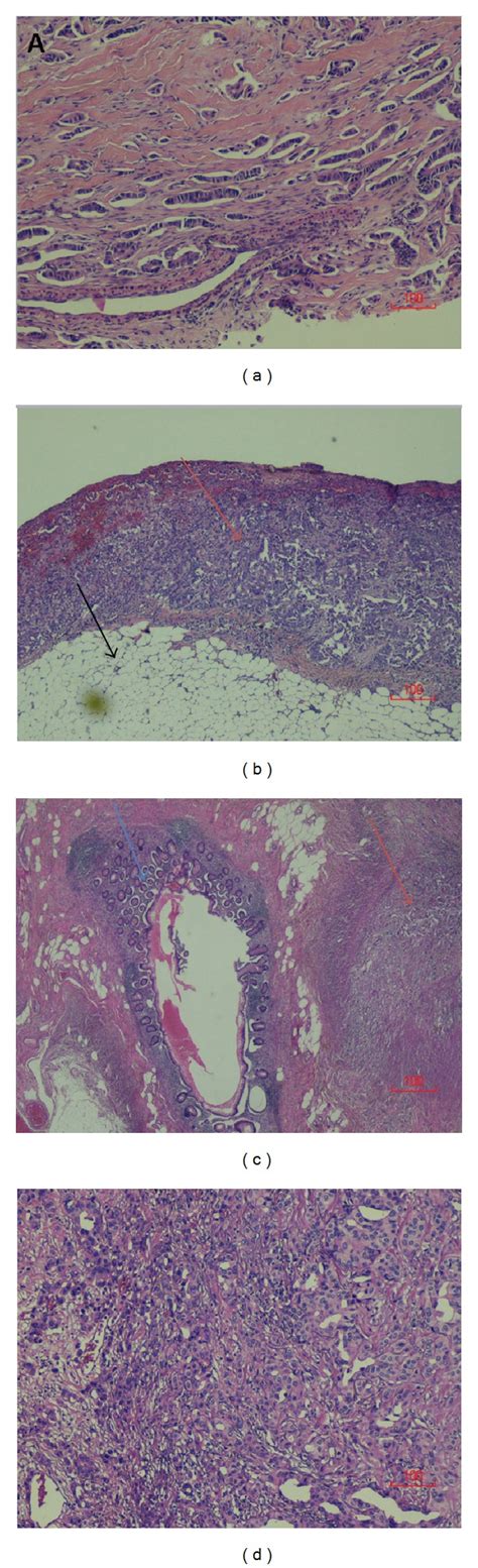A Core Needle Biopsy Of The Left Breast Shows An Invasive Moderately