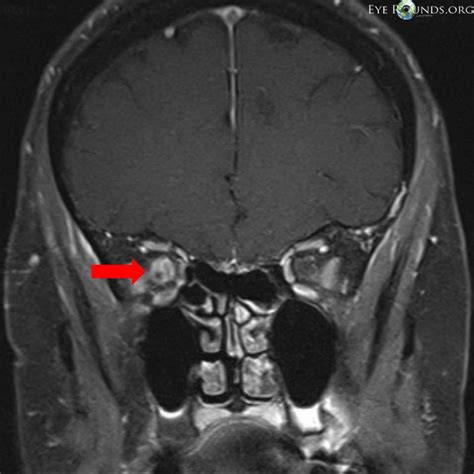 Atlas Entry Optic Nerve Sheath Meningioma