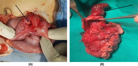 A B Intraoperative Photo Showing The Appendiceal Intussusception