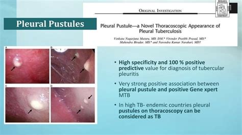 Role Of Thoracoscopy In Pleural Disease Pdf