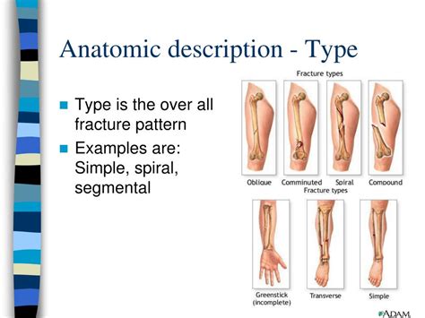 Ppt Fracture Classification Powerpoint Presentation Free Download