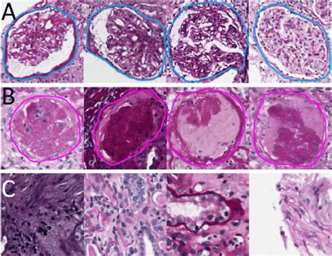 Examples Of Pas Stained Patches With Normal Glomeruli A Sclerosed