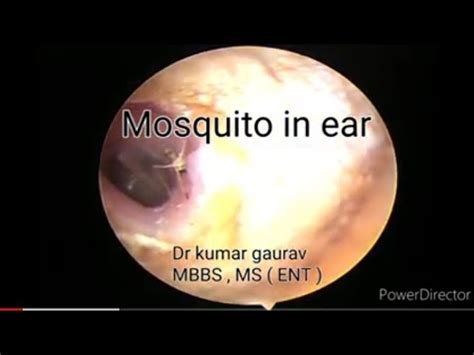 Mosquito In Ear 🥴 Youtube