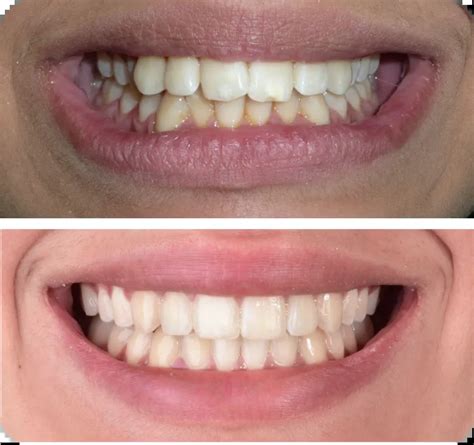 Clear Aligners Before And After Our Patients Speak For Us Eon Aligner