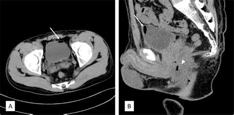 Abdominal Ct A Axial And B Sagittal Demonstrating Free Air In The