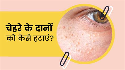 चेहरे के दाने कैसे हटाएं How To Remove Small Pimples From Face Naturally In Hindi How To
