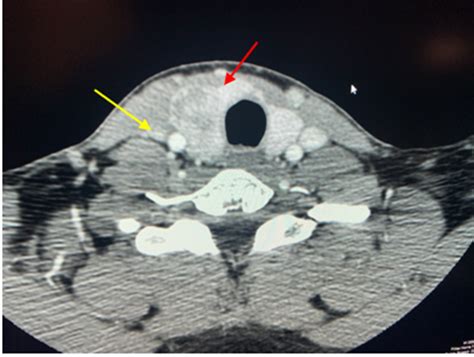 The 4 Reasons Lymph Nodes Are A Big Deal In Thyroid Surgery