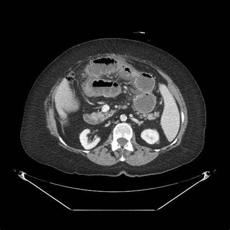 Closed Loop Small Bowel Obstruction Internal Hernia Radiopaedia