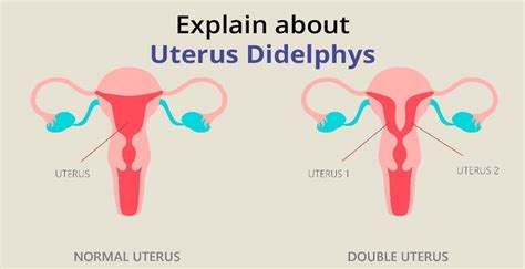 Uterus Didelphys Vaginal Opening
