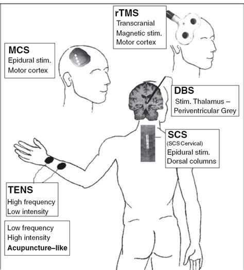 Noninvasive Neuromodulation Methods In The Treatment Of Chronic Pain