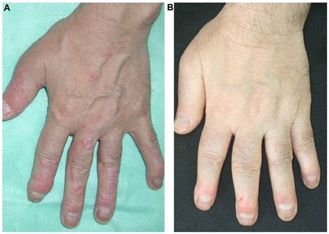 Optimal Management Of Dactylitis In Patients With Psoriatic Arthritis