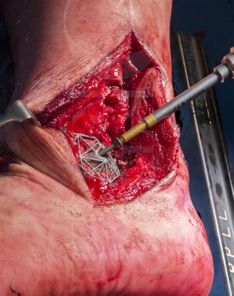 Tibio Talo Calcanealdouble Fusion Using 4web Custom Talar Replacement
