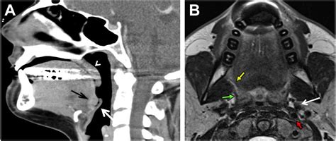 Anatomy And Imaging Of The Nasopharynx Oropharynx And Oral Cavity