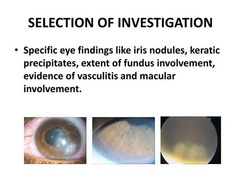 Ppt Investigations In Uveitis Powerpoint Presentation Free Download