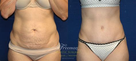 Tummy Tuck Before And After Stretch Marks