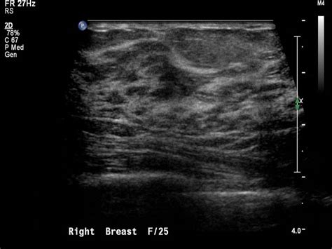 Atlas Of Breast Cancer Early Detection