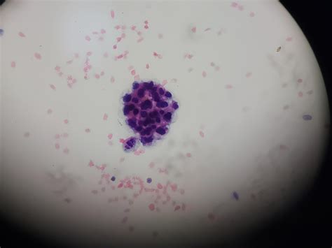 Is This Benign Or Malignant Mesothelial Cells Vs Lung Adenocarcinoma