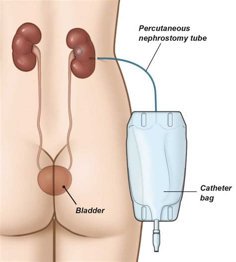Bilateral Nephrostomy