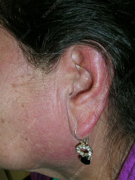 Dermatomyositis Stock Image C0611517 Science Photo Library