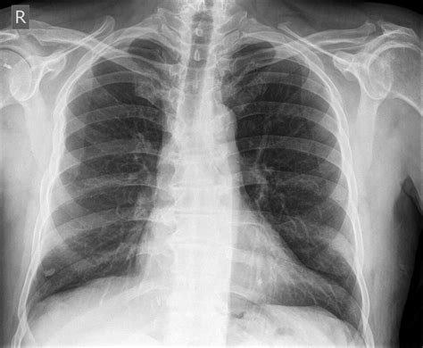 Lung Nodules On Chest X Ray Pulmonary Nodule Density Whui