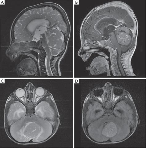 Figure 2 From A Case Of Cushing Ulcer In An 8 Month Old Patient With