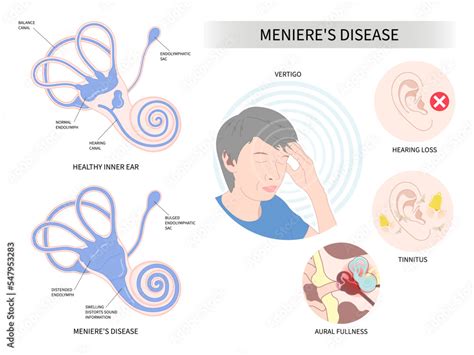 Symptoms Of The Menieres Disease Of Sound In Stuffy Ear Hear Ringing Roaring Buzzing Loss Of