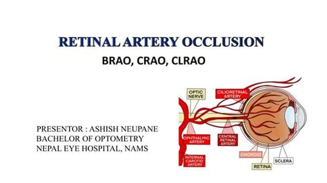 Retinal Artery Occlusions Crao Brao Clrao Pptx