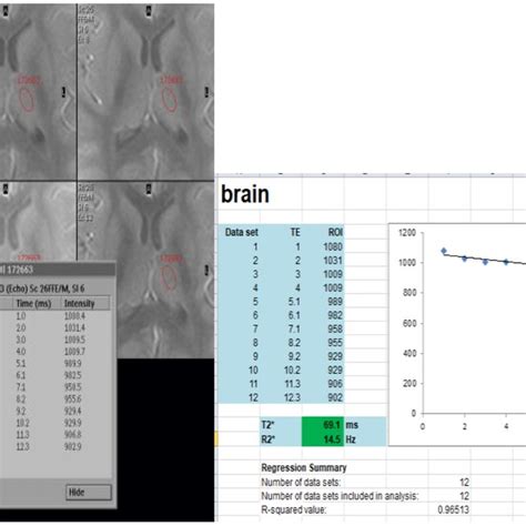 Multi Echo Fast Gradient Echo Brain Mri T2 Sequence Left Region Of