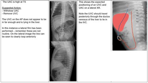 Umbilical Artery Catheter