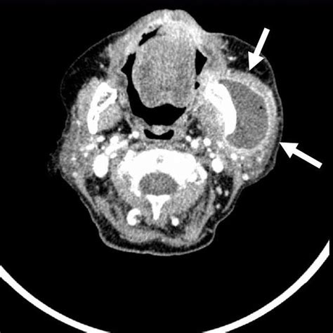 Pdf Submasseteric Abscess Caused By Mycoplasma Salivarium