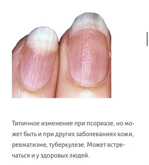 Pin de wanna***kraft_spb em болезни ногтей и кожи