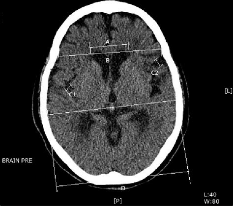 Measurement Of Brain Atrophy Using Frontal Horn Index Fhi And