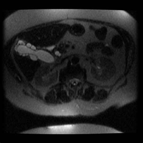 Adenomyomatosis Radiopaedia